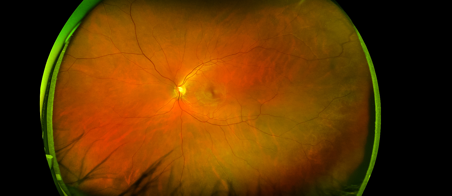 Eye Curtain Vision Treatment Options in Albuquerque